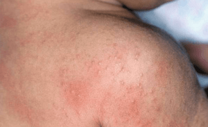 21 Common Causes of Small Red Dots on Skin