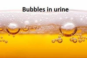 Bubbles in Urine: 12 Common Causes with Treatments
