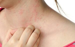 How to Get Rid of a Skin Rash: 14 Natural Remedies