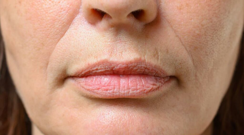 14 Natural Ways to Get Rid of Wrinkles Around Mouth