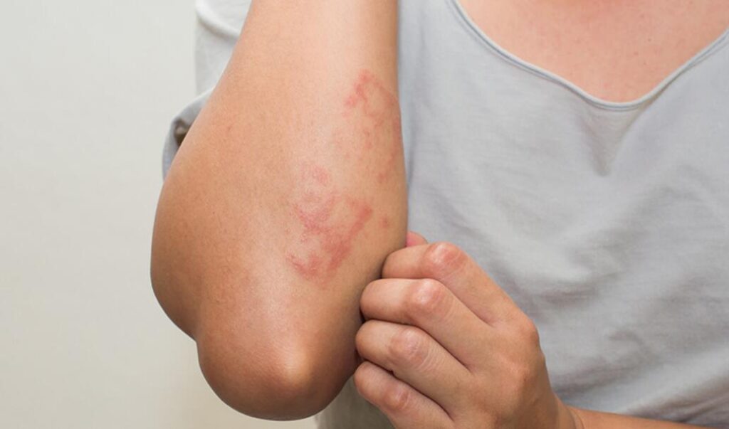How to Get Rid of Eczema:16 Natural Remedies May Help