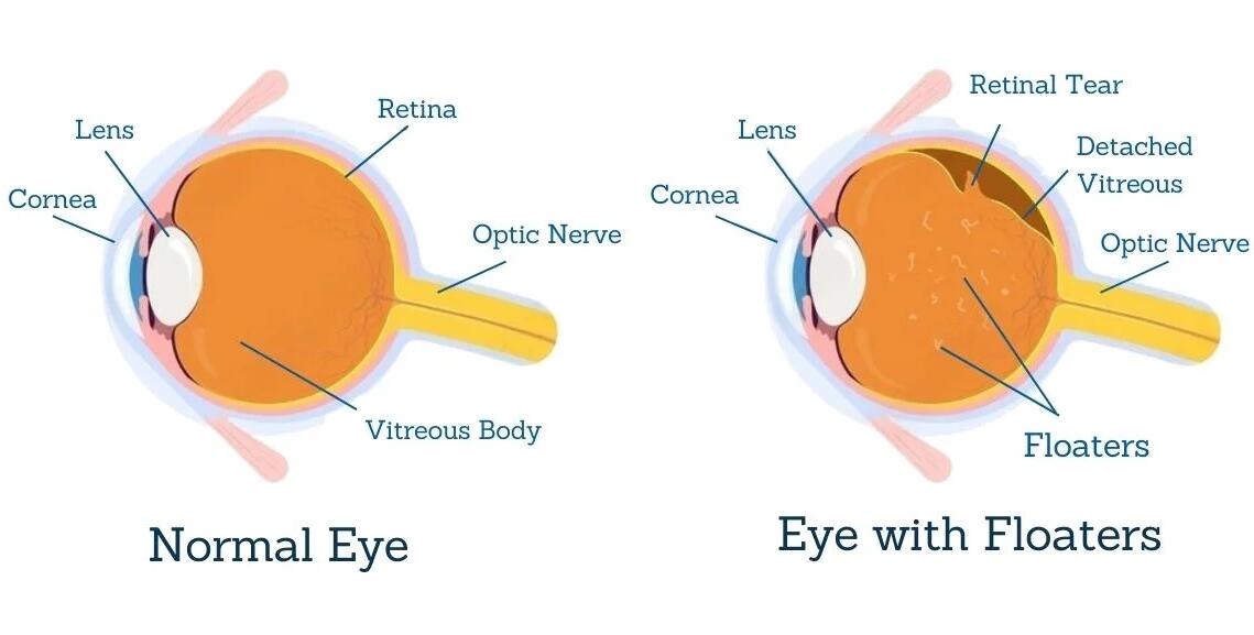 How to Get Rid of Eye Floaters:16 Natural Remedies